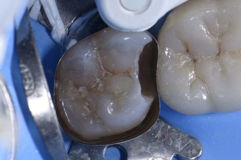 Deep Margin Elevation in Restorative Dentistry