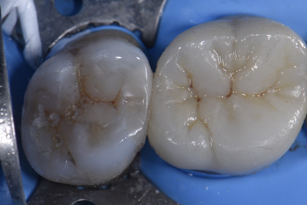 Deep Margin Elevation in Restorative Dentistry
