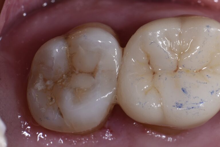 Deep Margin Elevation in Restorative Dentistry