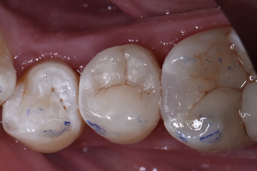 Restoring Large Cavities Predictably with a Crown alternative
