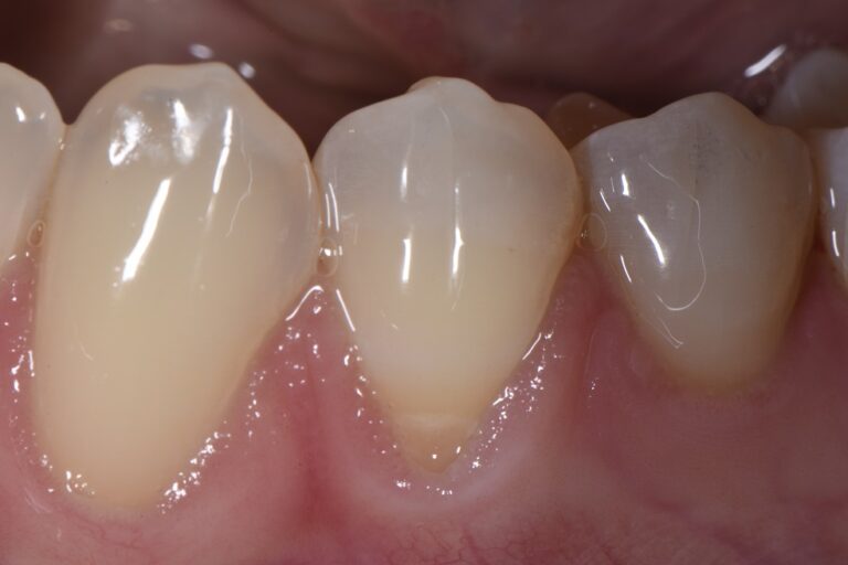 Class V isolation difficulties and considerations