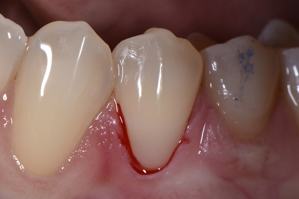 Class V isolation difficulties and considerations