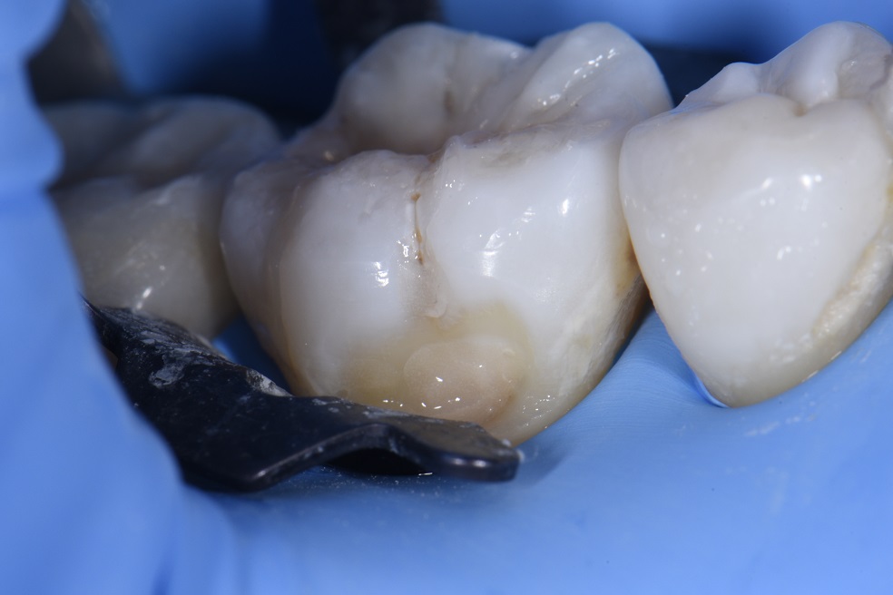 Difficult Isolation for this Complex Layered Composite Restoration