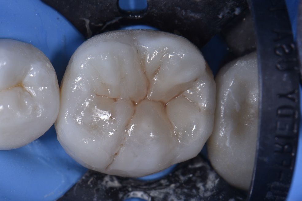 Difficult Isolation for this Complex Layered Composite Restoration