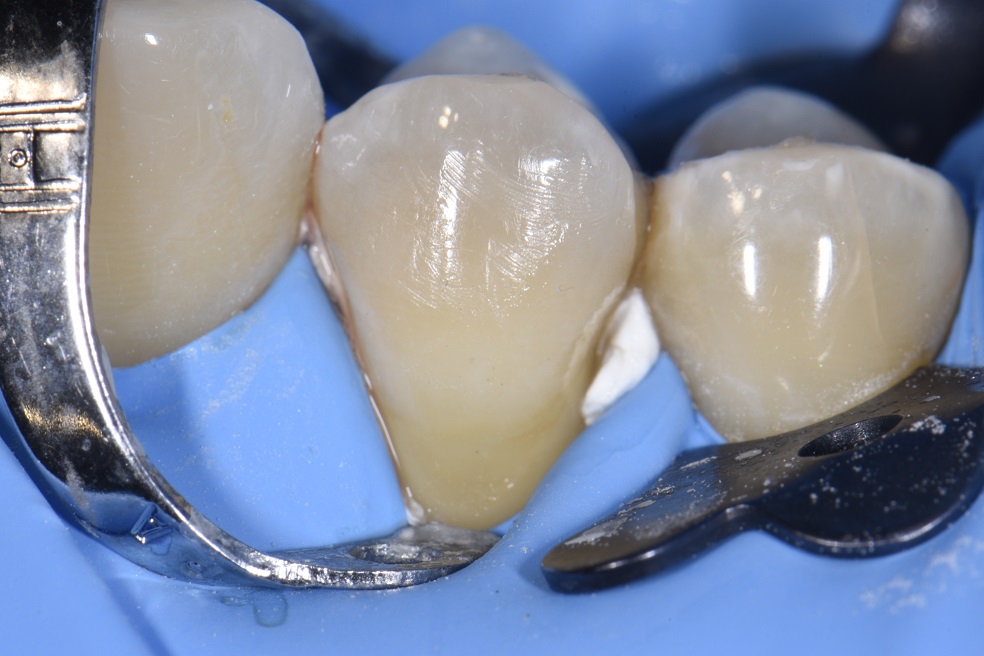 Full Isolation Class V resin restorations