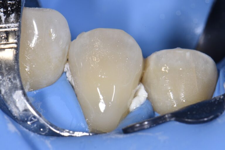 Full Isolation Class V Resin Restorations