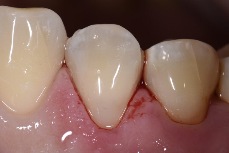 Full Isolation Class V resin restorations