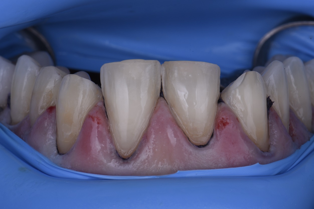 Veneer Preparations and Provisionalization Temporization