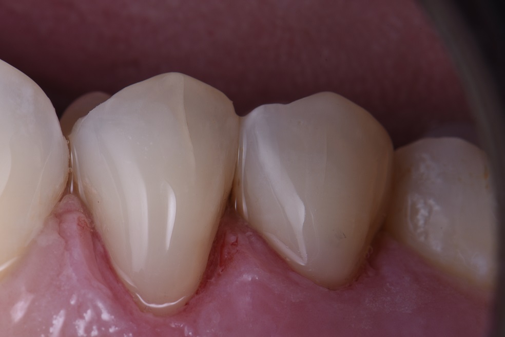 Class V restorations to seal dentin