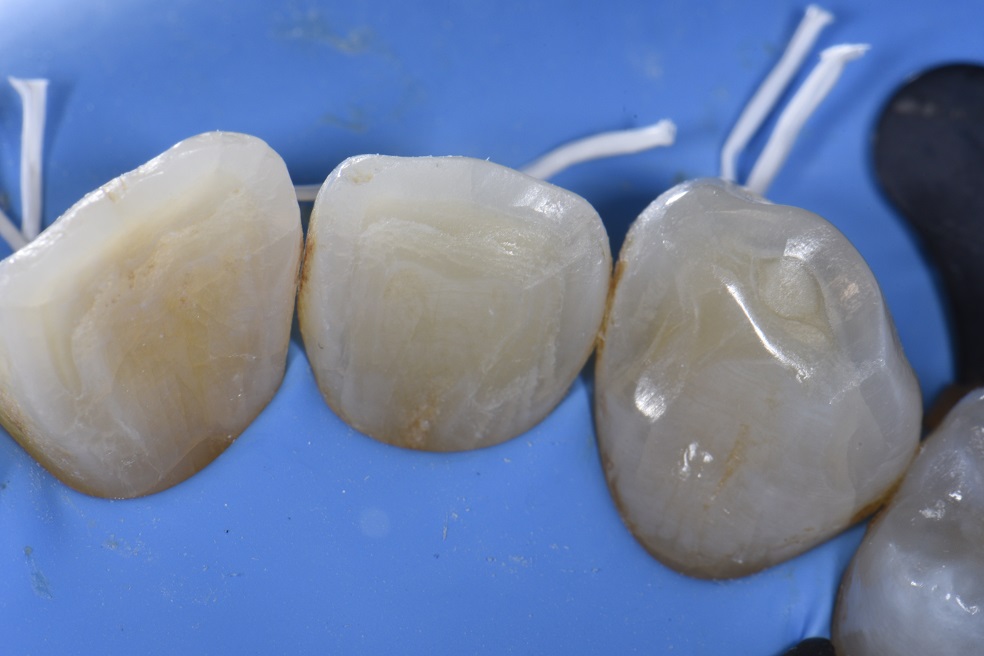 Class III restorations