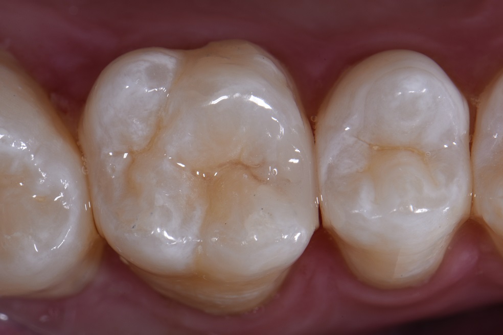 Classic Grade 3 Cavities Caries Restored