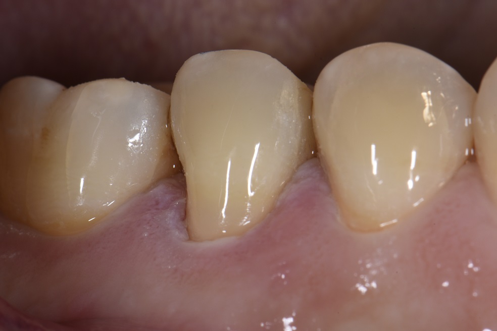 Small Class V root protection restorations