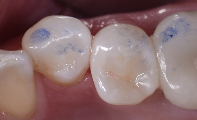 Class II slot restorations