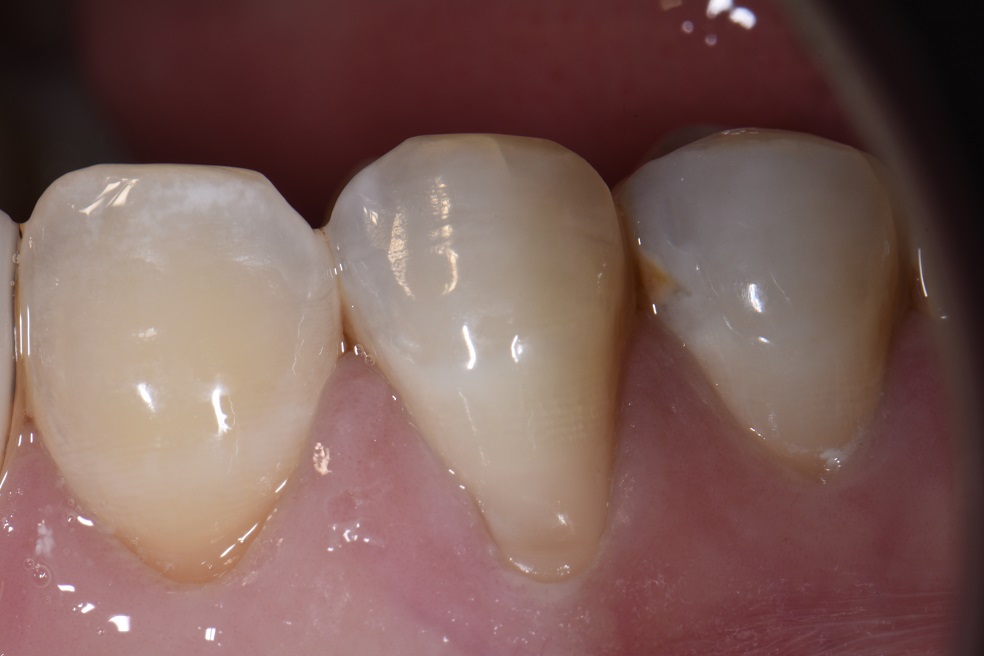 Seamless cervical composite restorations NCCL