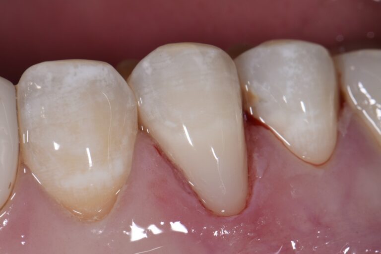 Seamless cervical composite restorations NCCL