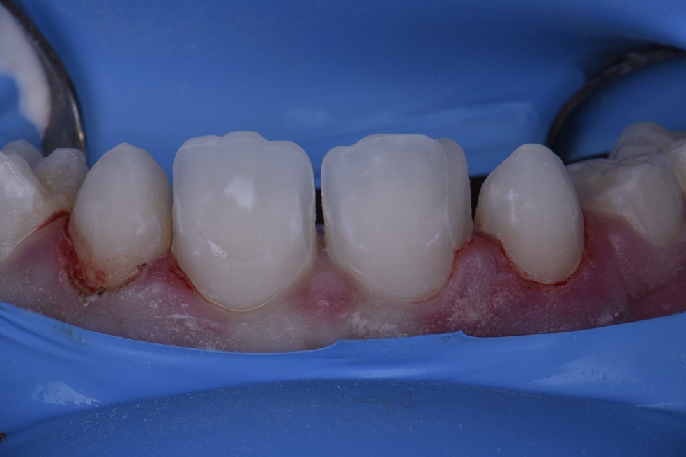 Camouflaging canines as lateral incisors in smile design