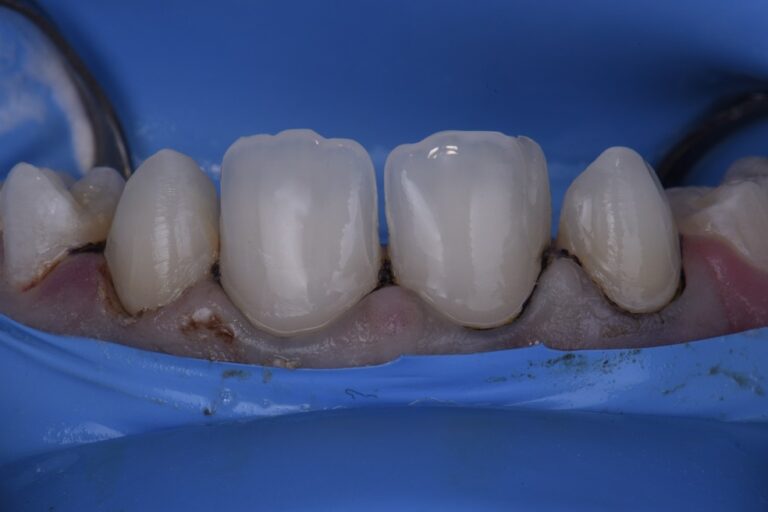 Camouflaging canines as lateral incisors in smile design