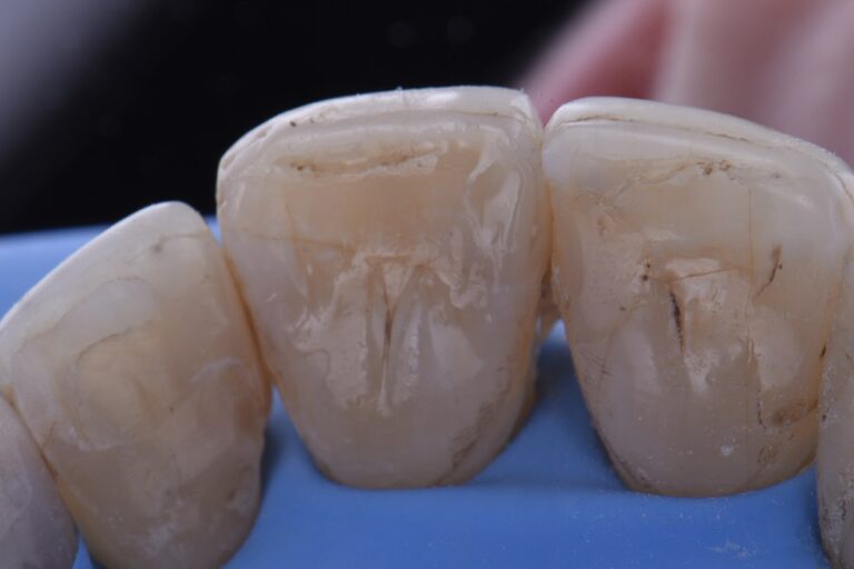 Class III full isolation bonded composite resin