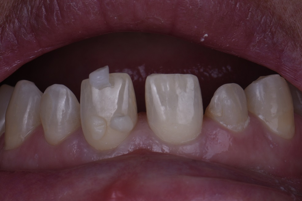 Large gap diastema closures and gum recontouringLarge gap diastema ...