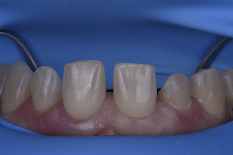 Large gap diastema closures and gum recontouringLarge gap diastema ...