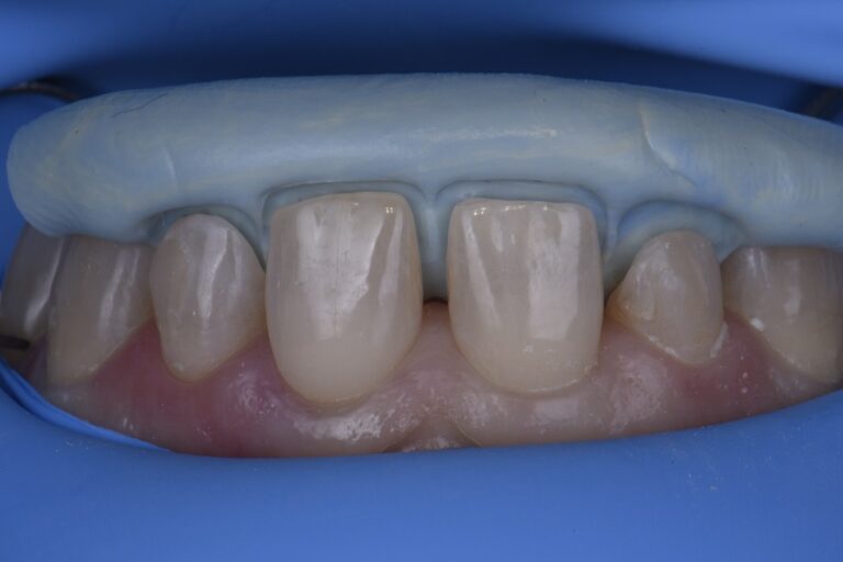 Large gap diastema closures and gum recontouringLarge gap diastema ...