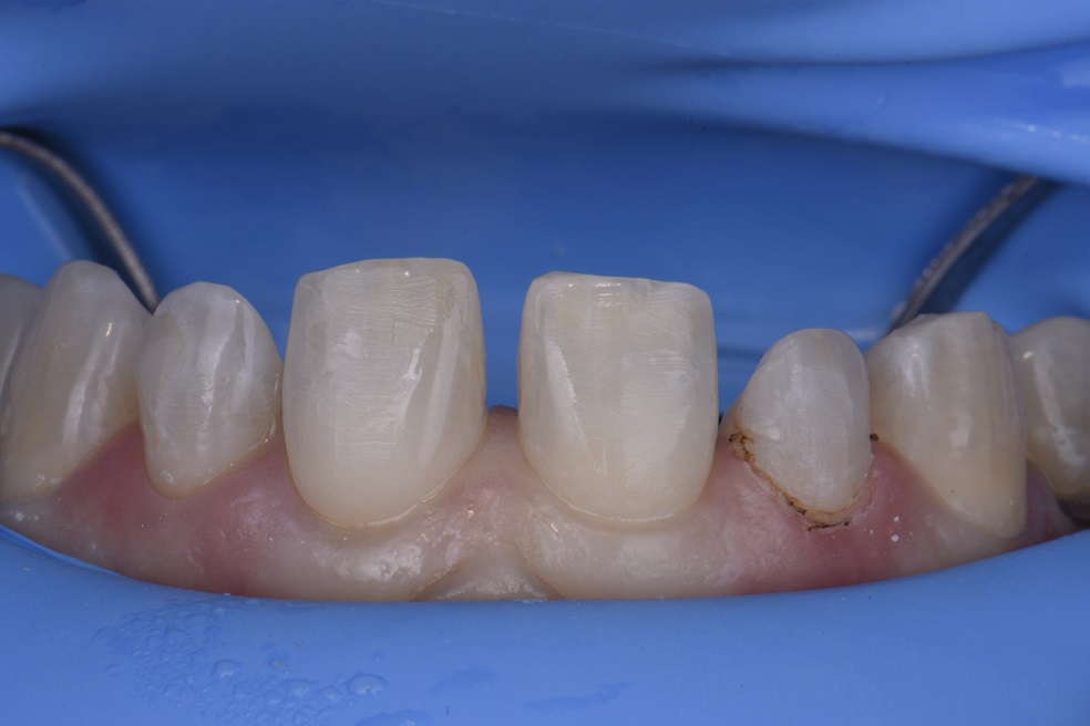 Large gap diastema closures and gum recontouringLarge gap diastema ...