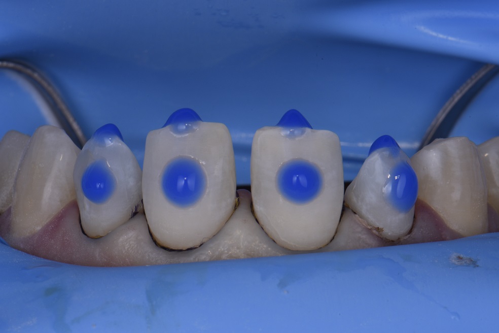 Large gap diastema closures and gum recontouringLarge gap diastema ...