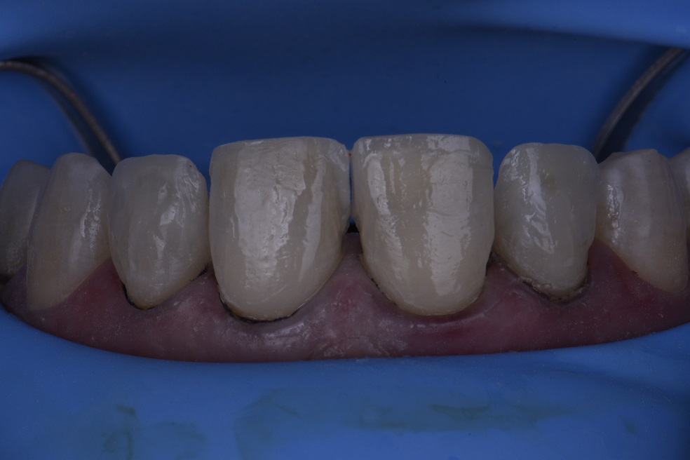 Large gap diastema closures and gum recontouringLarge gap diastema ...