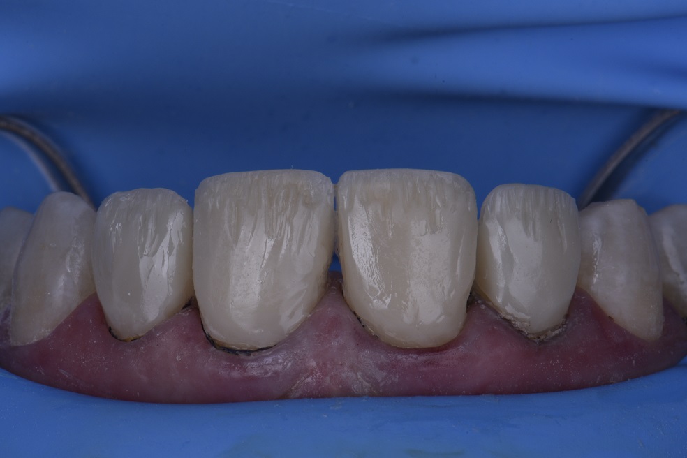 Large gap diastema closures and gum recontouringLarge gap diastema ...