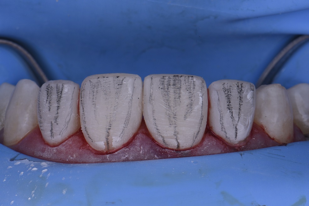 Large gap diastema closures and gum recontouringLarge gap diastema ...