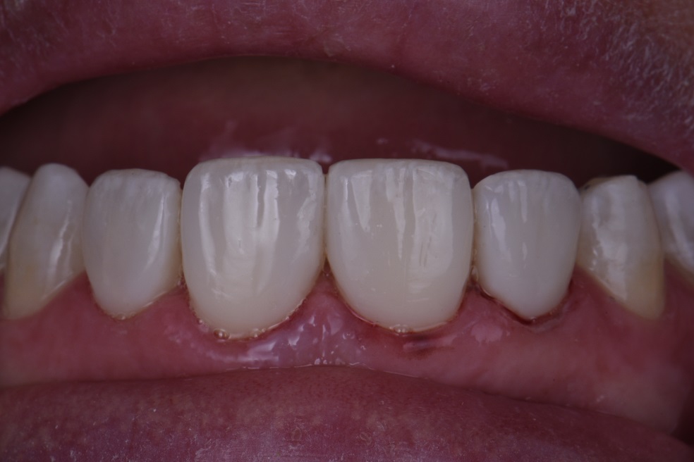 Large gap diastema closures and gum recontouringLarge gap diastema ...