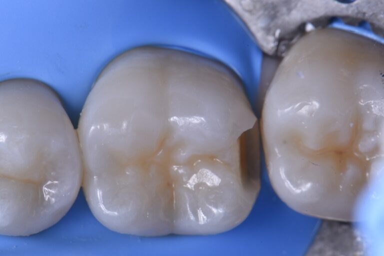 Conservative slot preps to remove interproximal caries