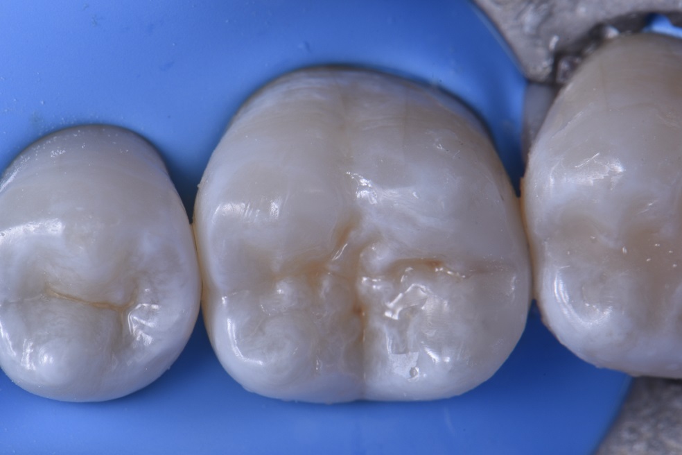 Conservative slot preps to remove interproximal caries