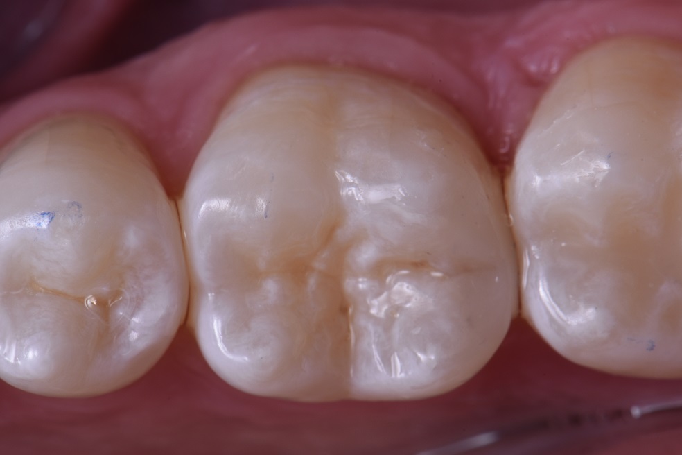 Conservative slot preps to remove interproximal caries