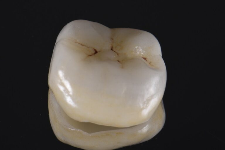 Crown for root canal treated teeth