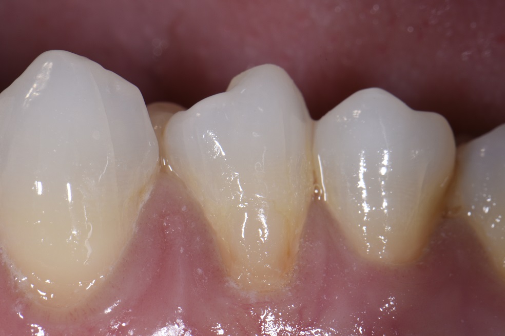 Replacing Old Class V Restorations