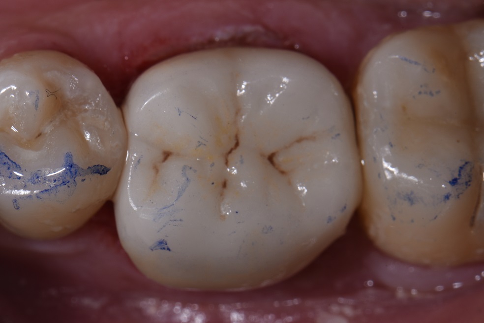 Crown for root canal treated teeth
