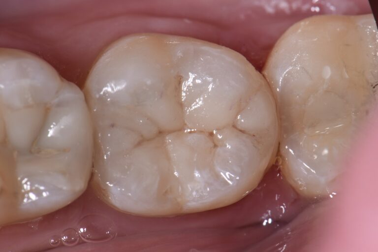 Partial filling replacements with new composite resin
