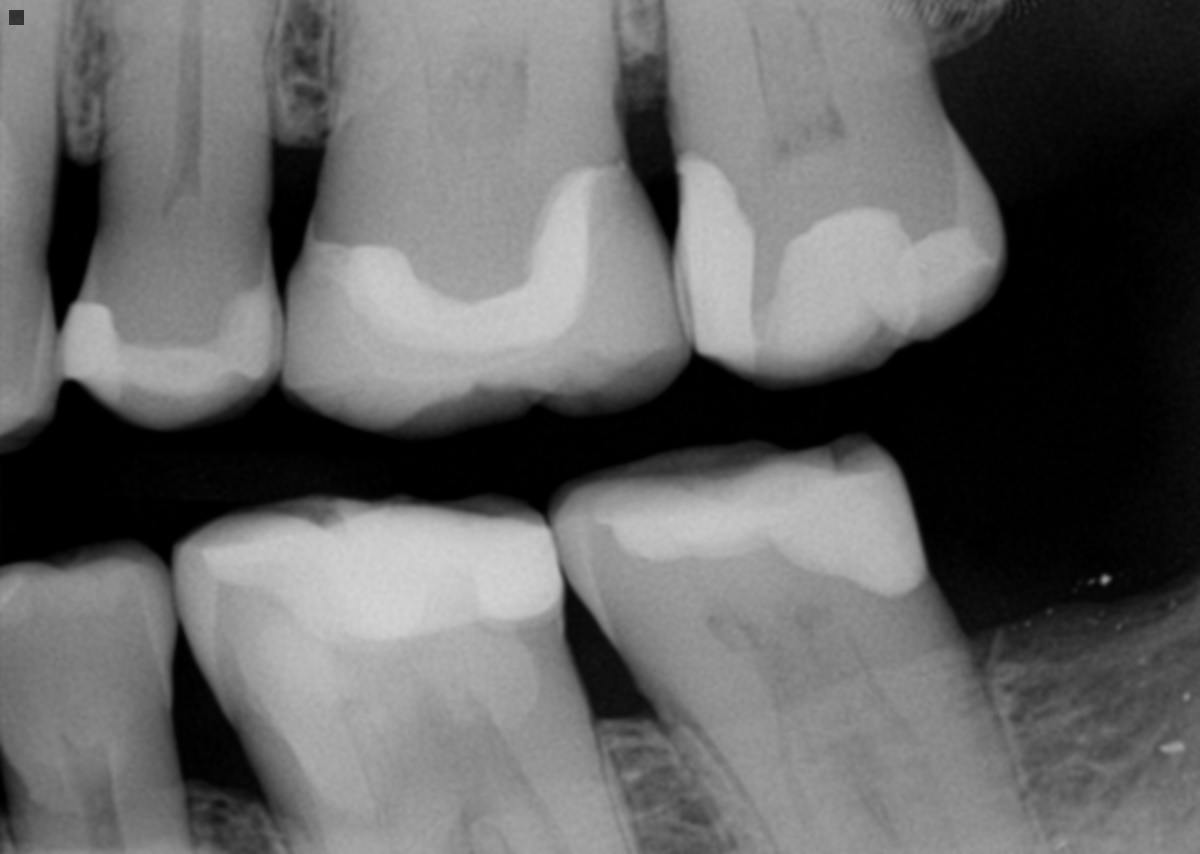 Deep Margin Elevation in Restorative Dentistry