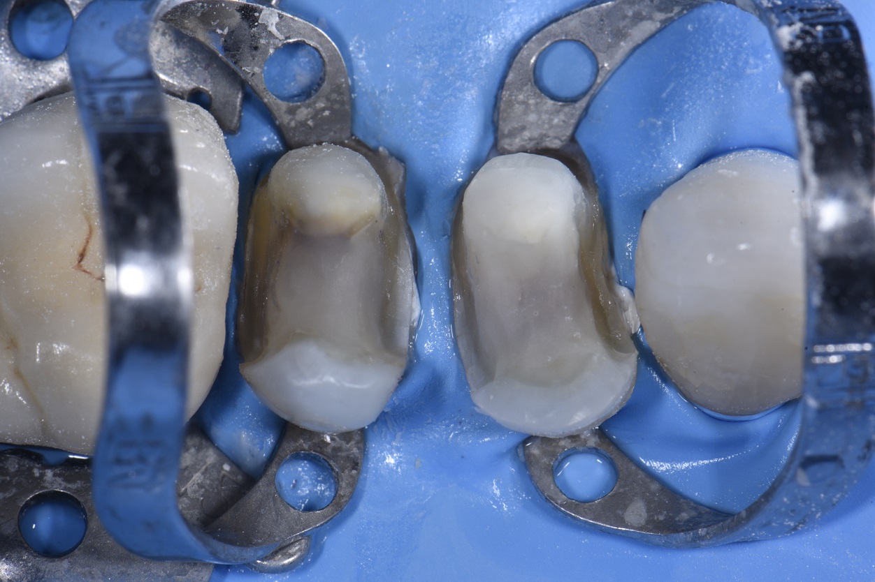 Translucent conservative porcelain onlay and overlays