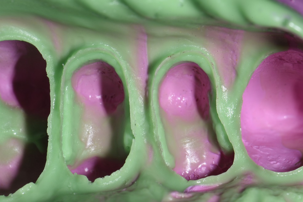 Translucent conservative porcelain onlay and overlays