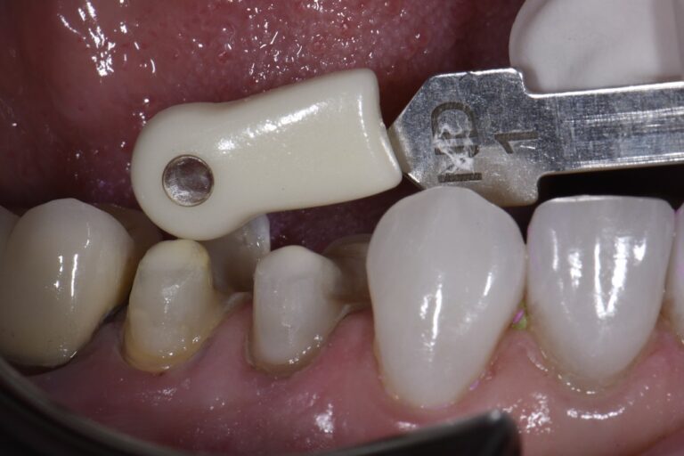 Translucent conservative porcelain onlay and overlays