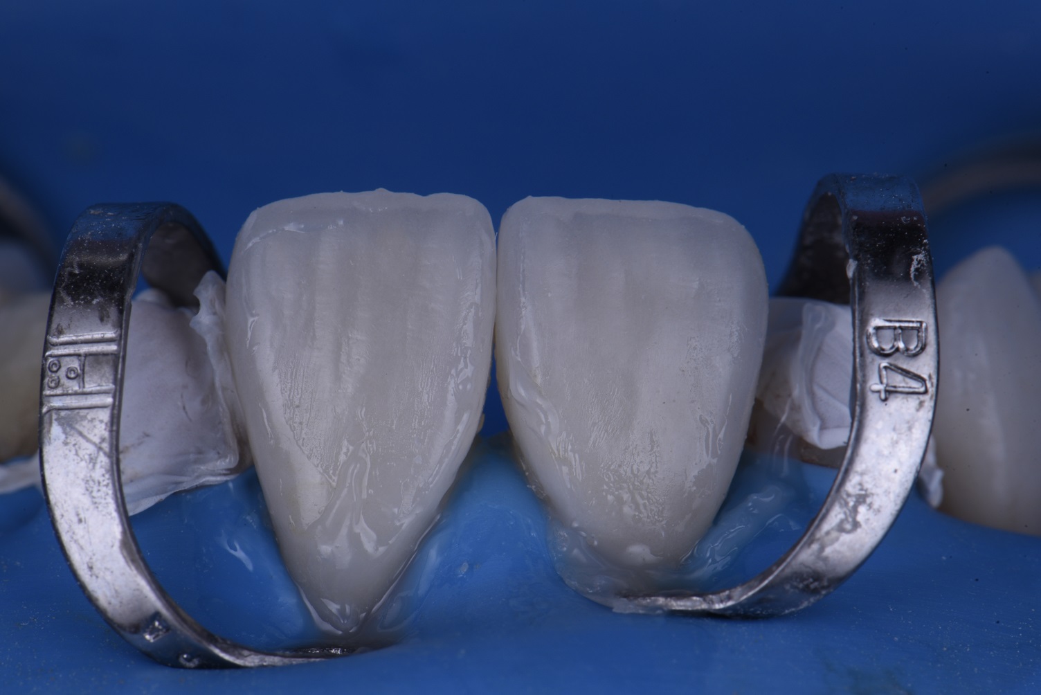 Cementation Workflow using Ultimate Isolation