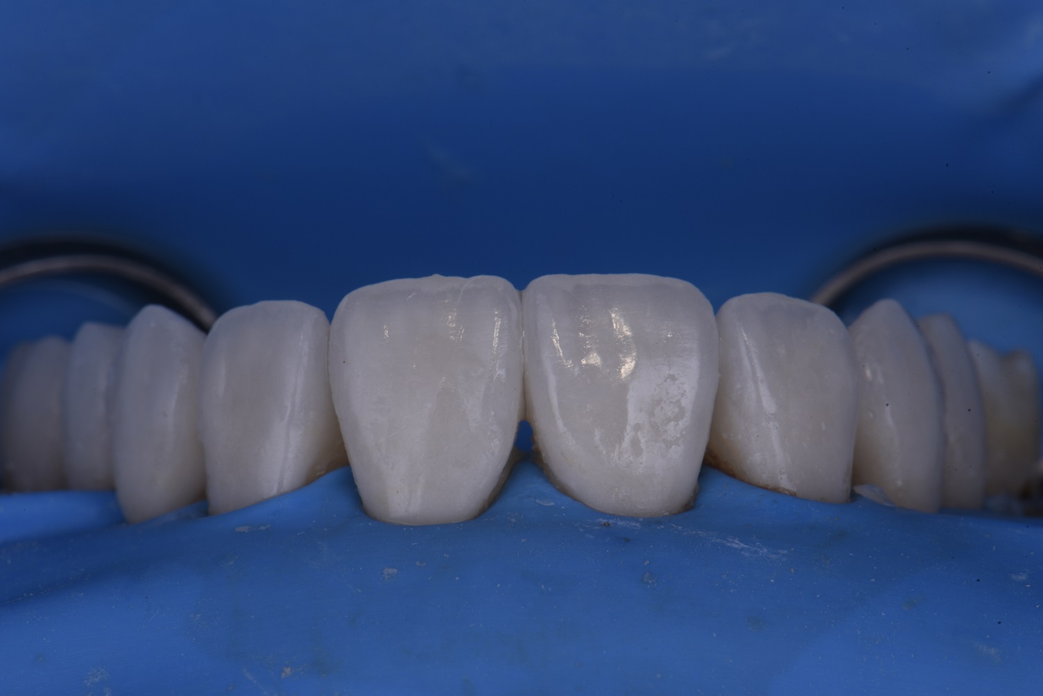 Cementation Workflow using Ultimate Isolation