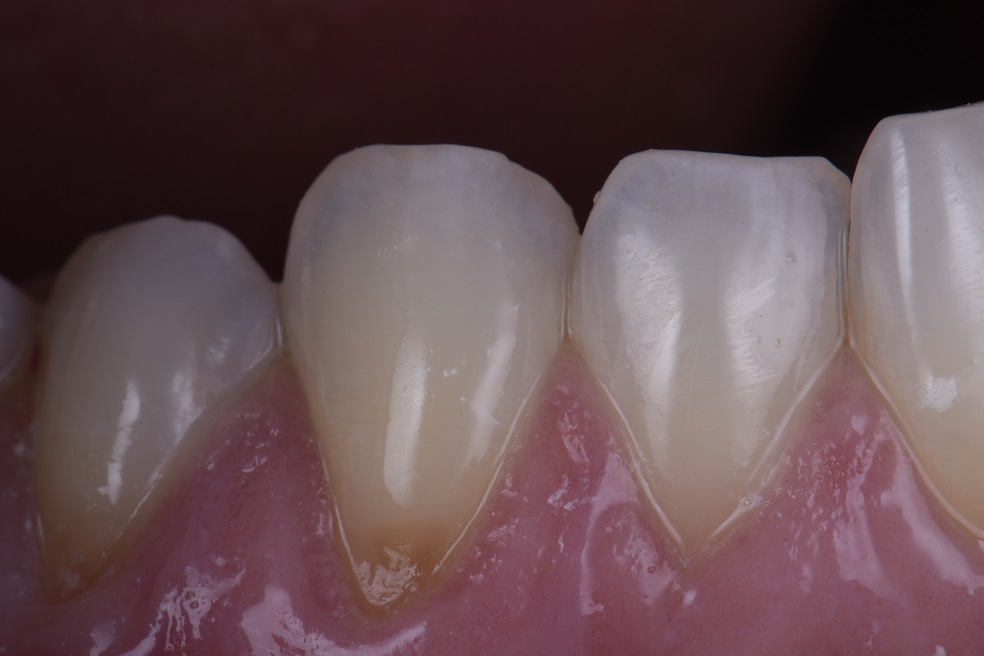 Root coverage composite resin restorations