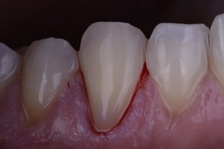 Root coverage composite resin restorations