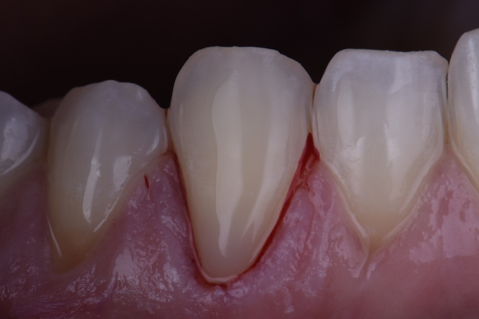 Root coverage composite resin restorations