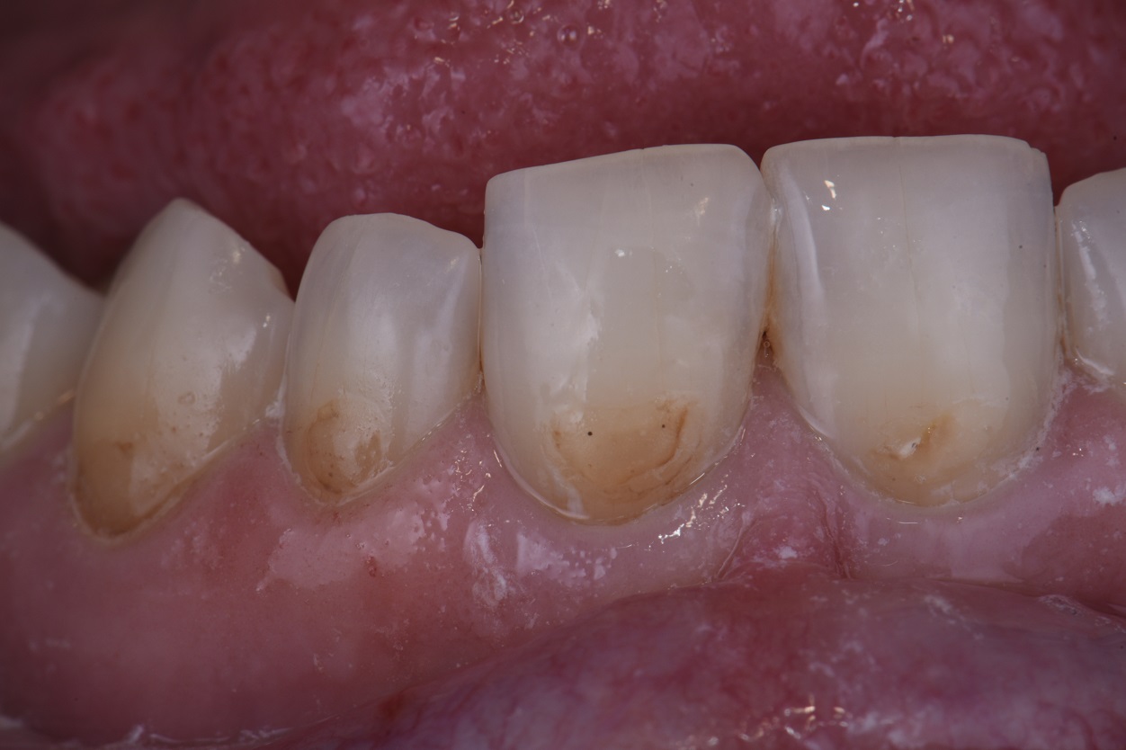 Superpolishable composites for Class V repair