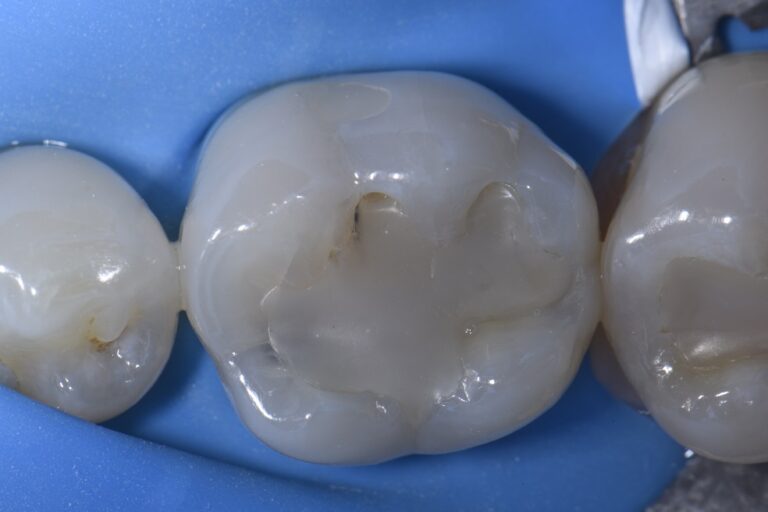 Class I restoration replacement