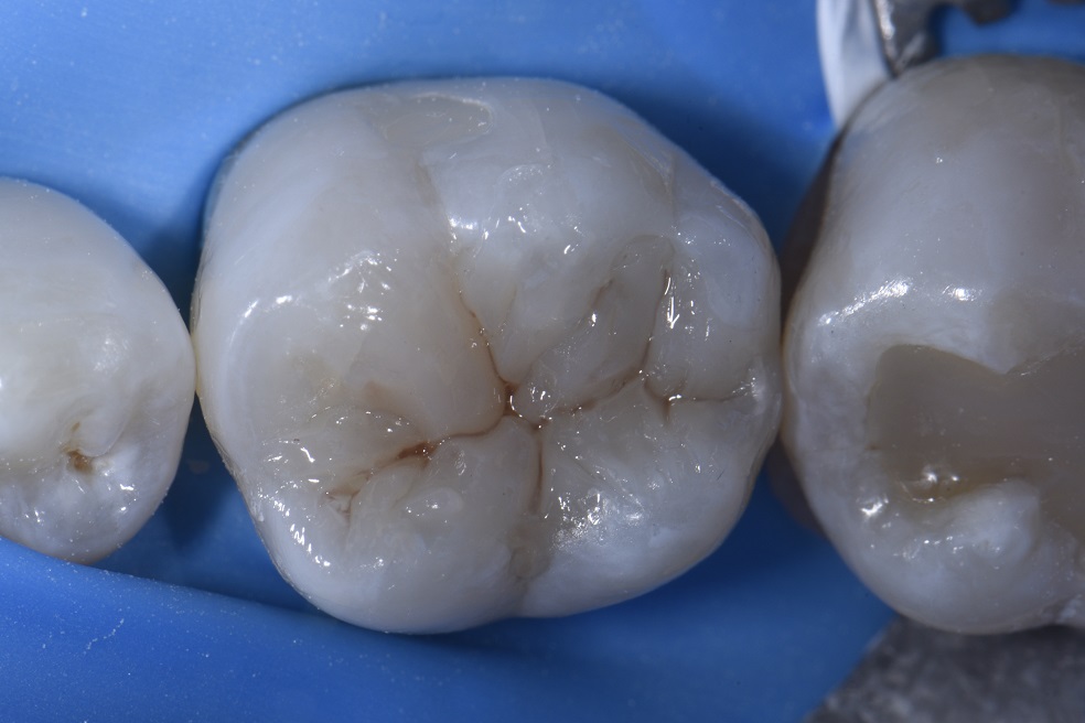 Class I restoration replacement